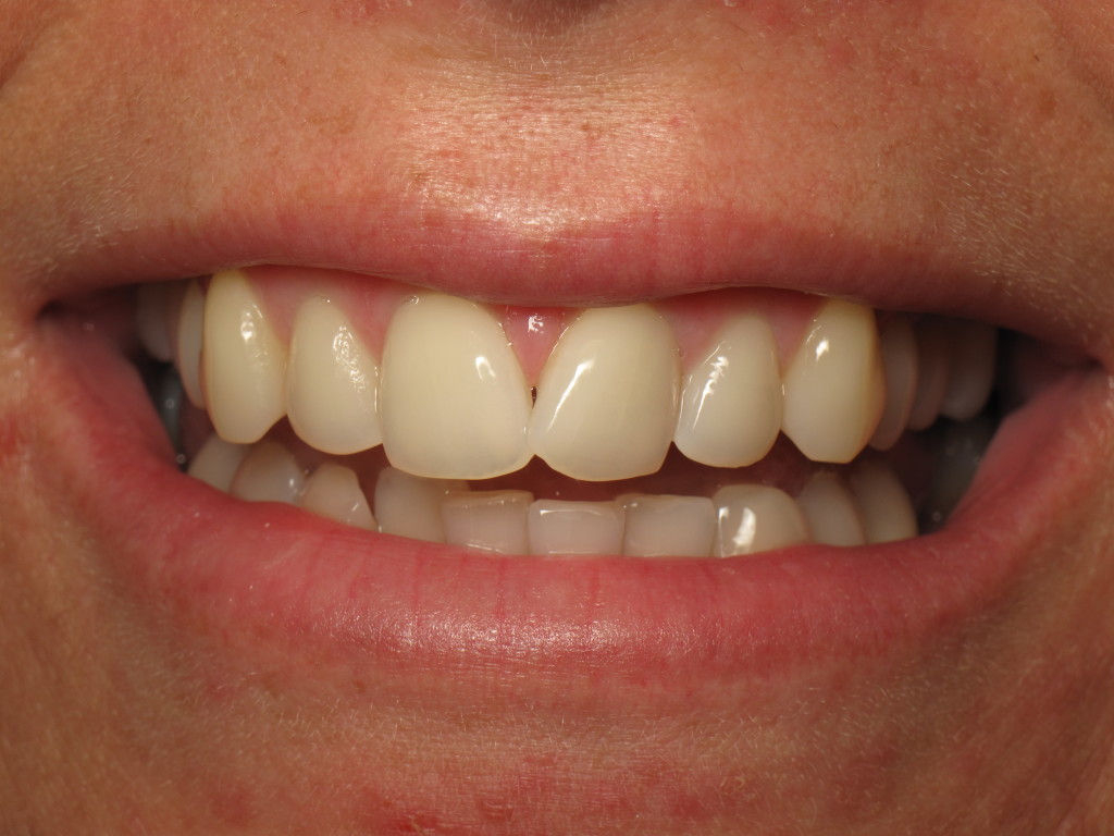 AcceleDent Aura La Jolla - Fast Teeth Alignment | Weston Spencer DDS
