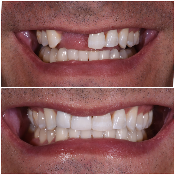 Dental Implants La Jolla - Tooth Replacement | Weston Spencer DDS